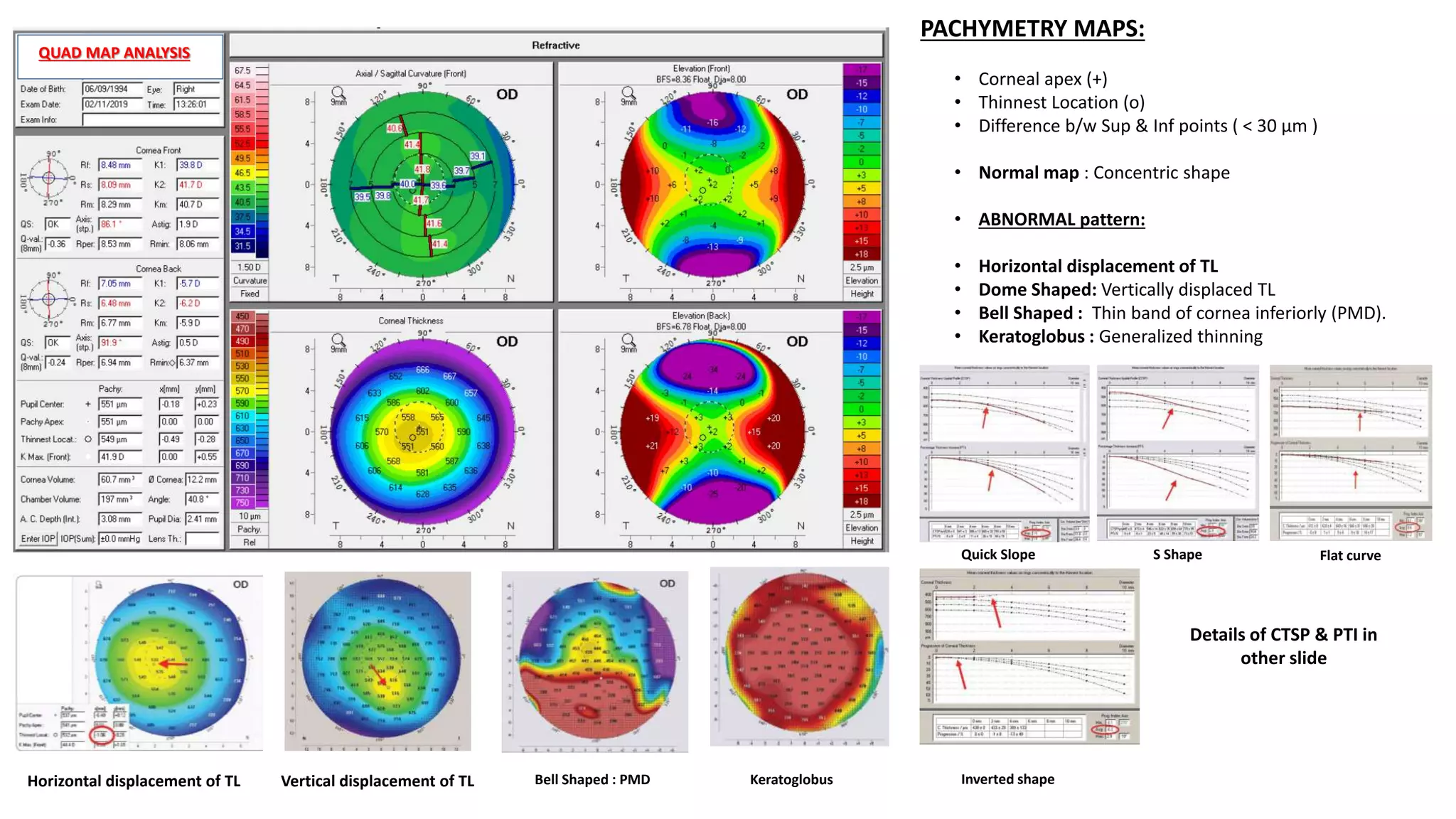 Pentacam analysis | PPTX
