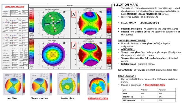 Pentacam analysis | PPTX | Eye and Vision Conditions | Diseases and ...