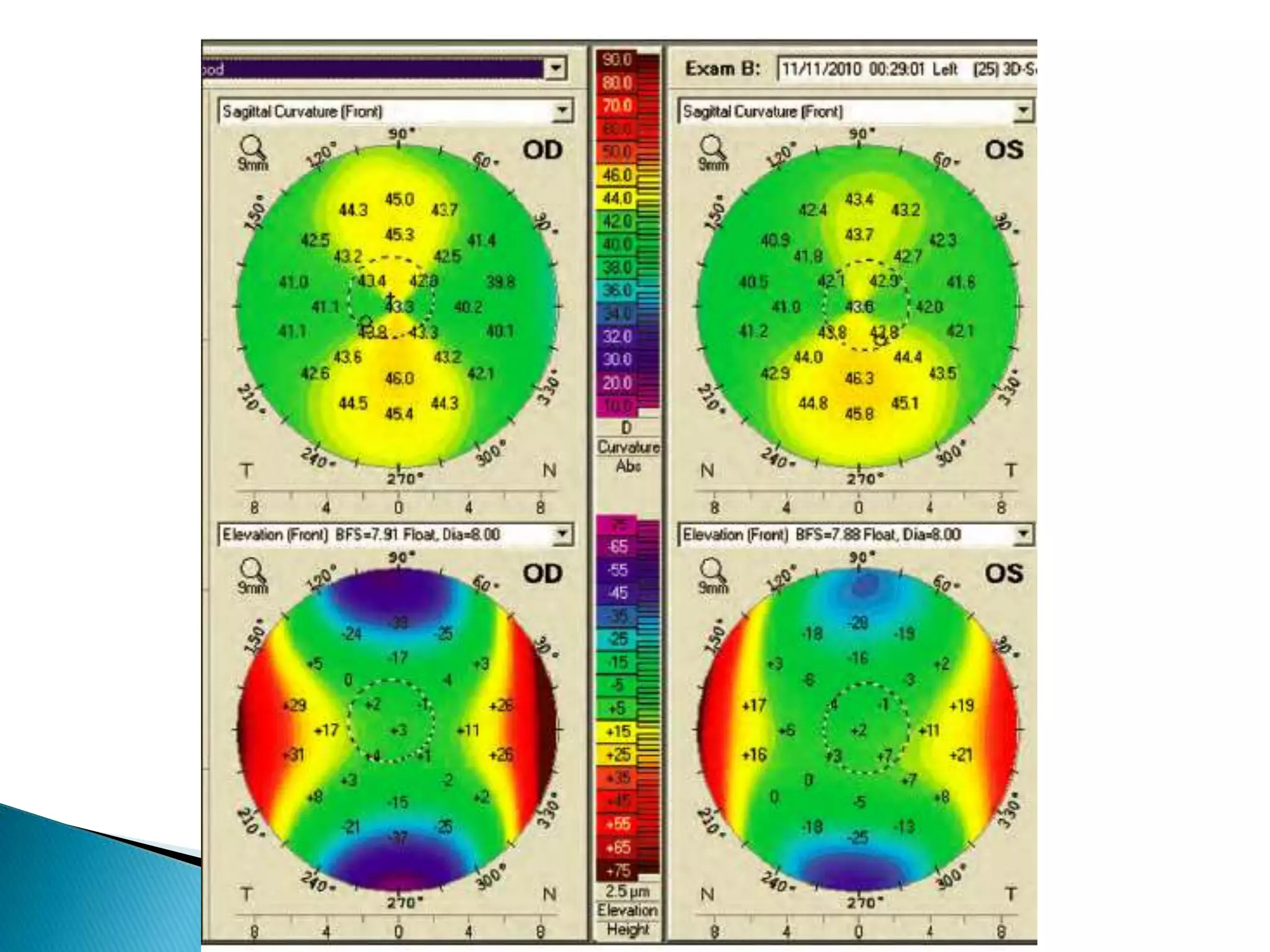 Pentacam and topography | PPTX