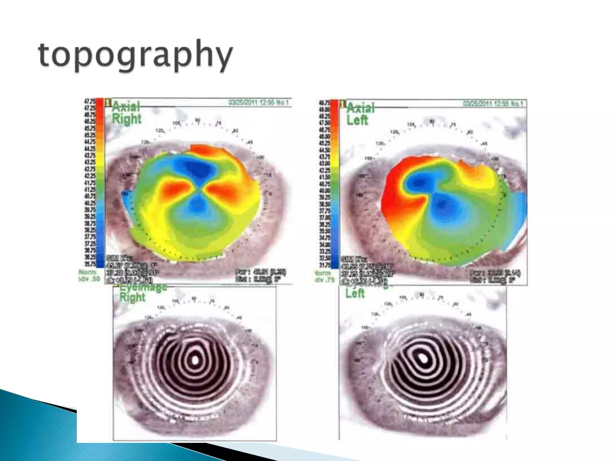 Pentacam and topography | PPTX