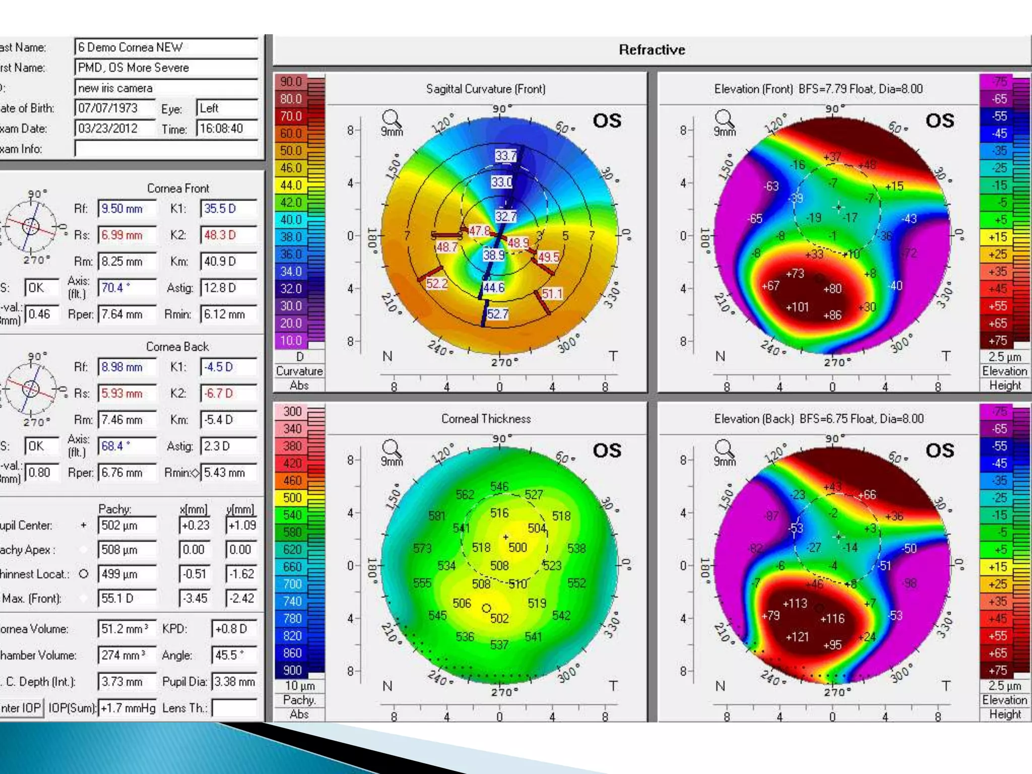 Pentacam and topography | PPTX