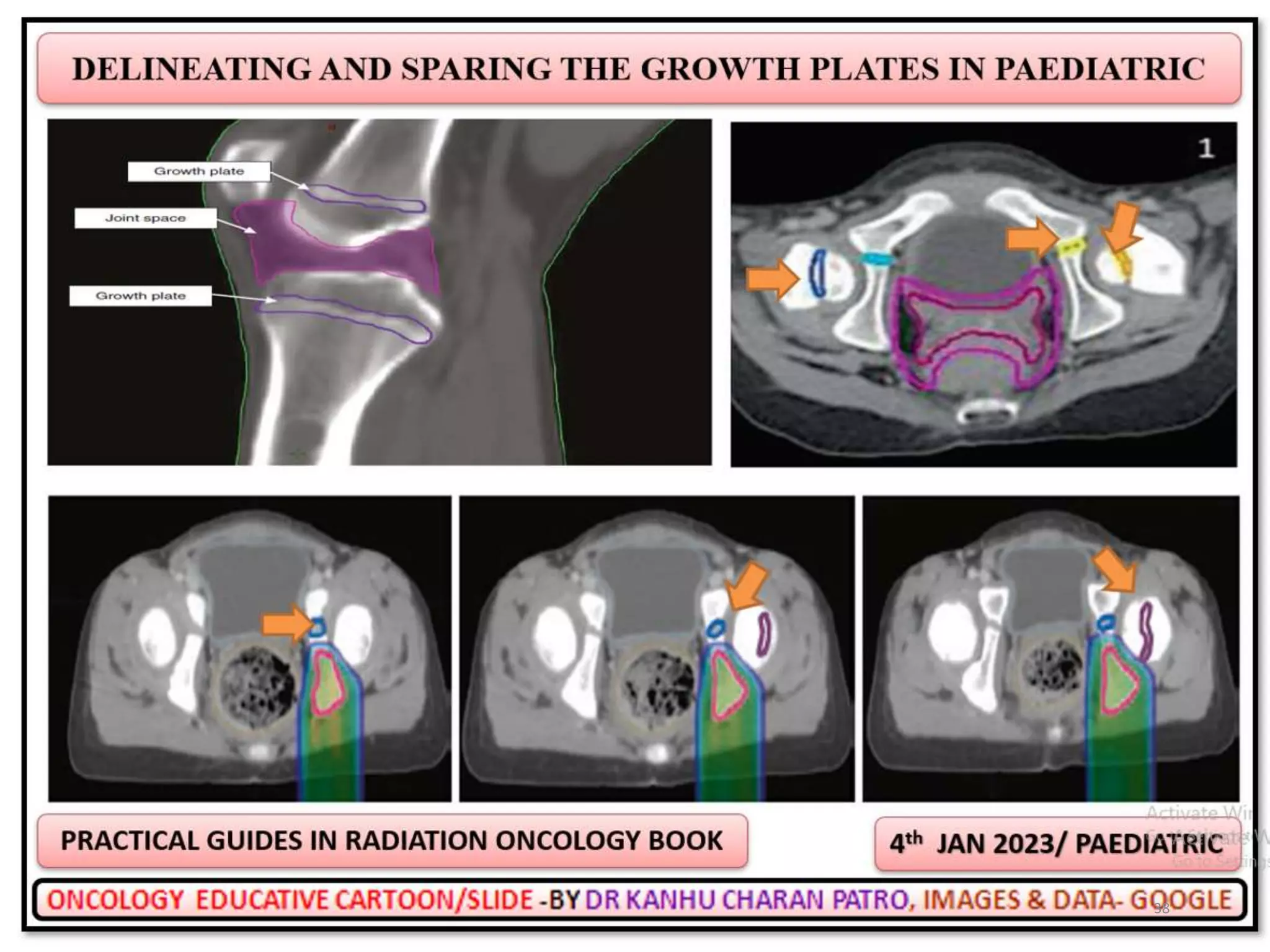 PENTEC GUIDELINES FOR PAEDIATRIC RADIOTHERAPY | PPTX