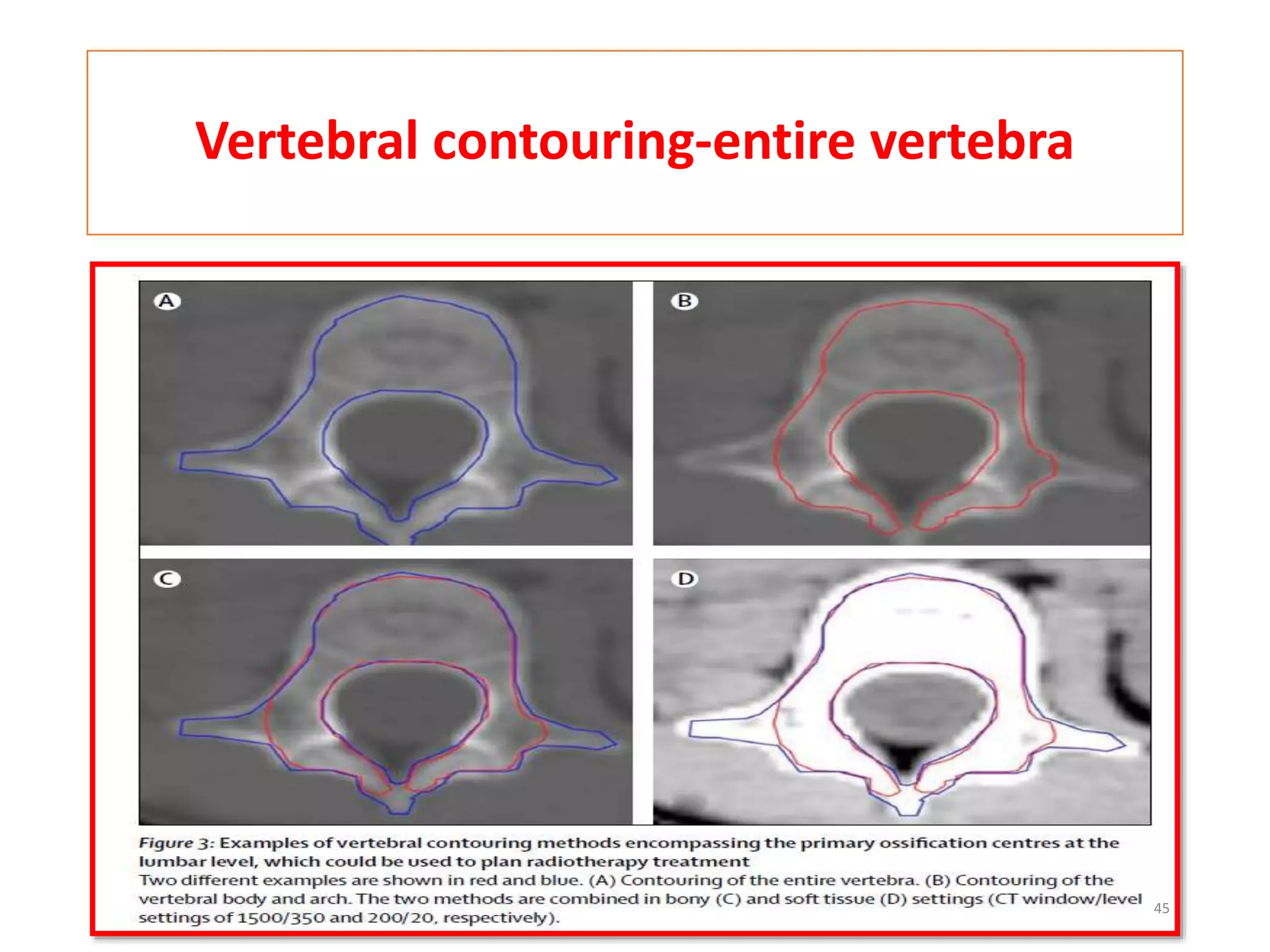 PENTEC GUIDELINES FOR PAEDIATRIC RADIOTHERAPY | PPTX