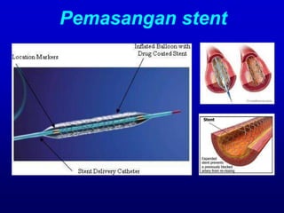 Penyakit jantung-koroner rrrrrr | PPT