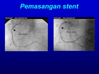 Penyakit jantung-koroner rrrrrr | PPT