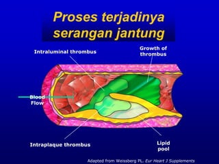 Penyakit jantung-koroner rrrrrr | PPT