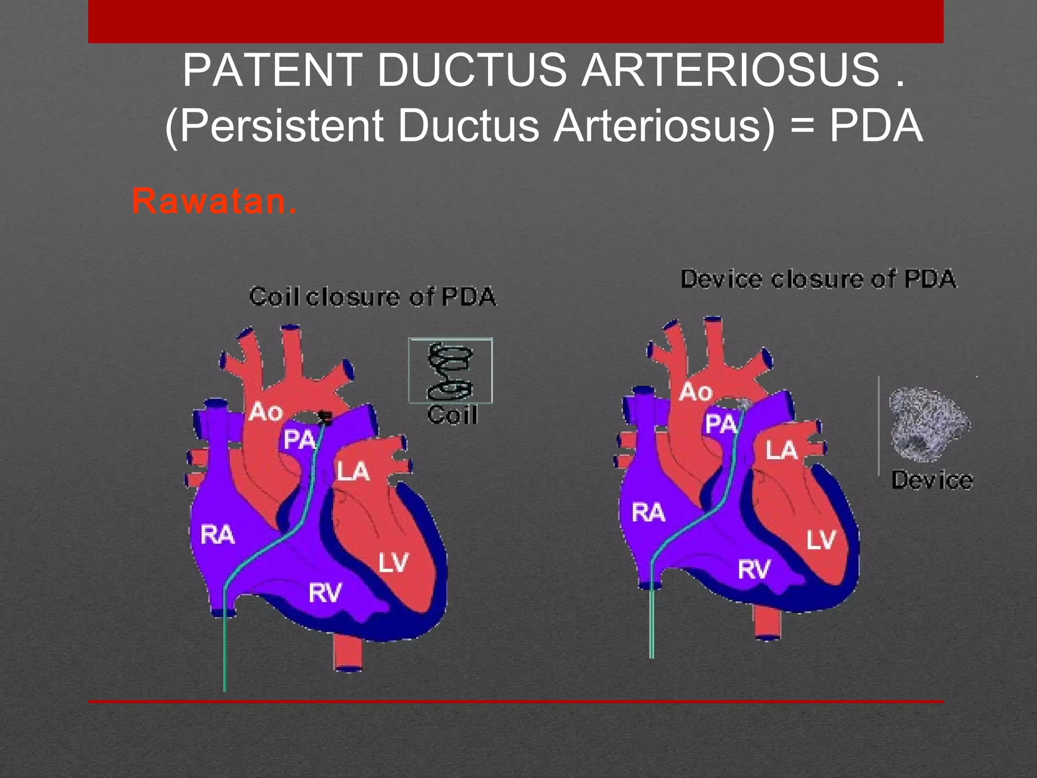 PENYAKIT-PENYAKIT JANTUNG KONGENITAL | PPT