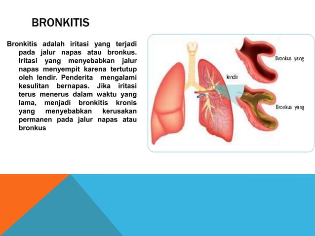 Penyakit - penyakit pada sistem pernapasan oleh rokok.ppt