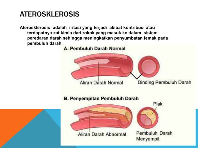 Penyakit - penyakit pada sistem pernapasan oleh rokok.ppt