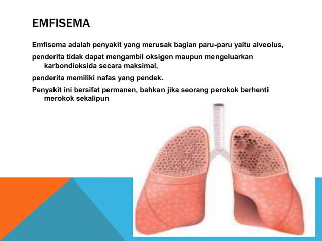Penyakit - penyakit pada sistem pernapasan oleh rokok.ppt