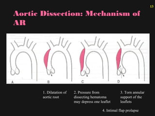 Penyakit aorta awam | PPT