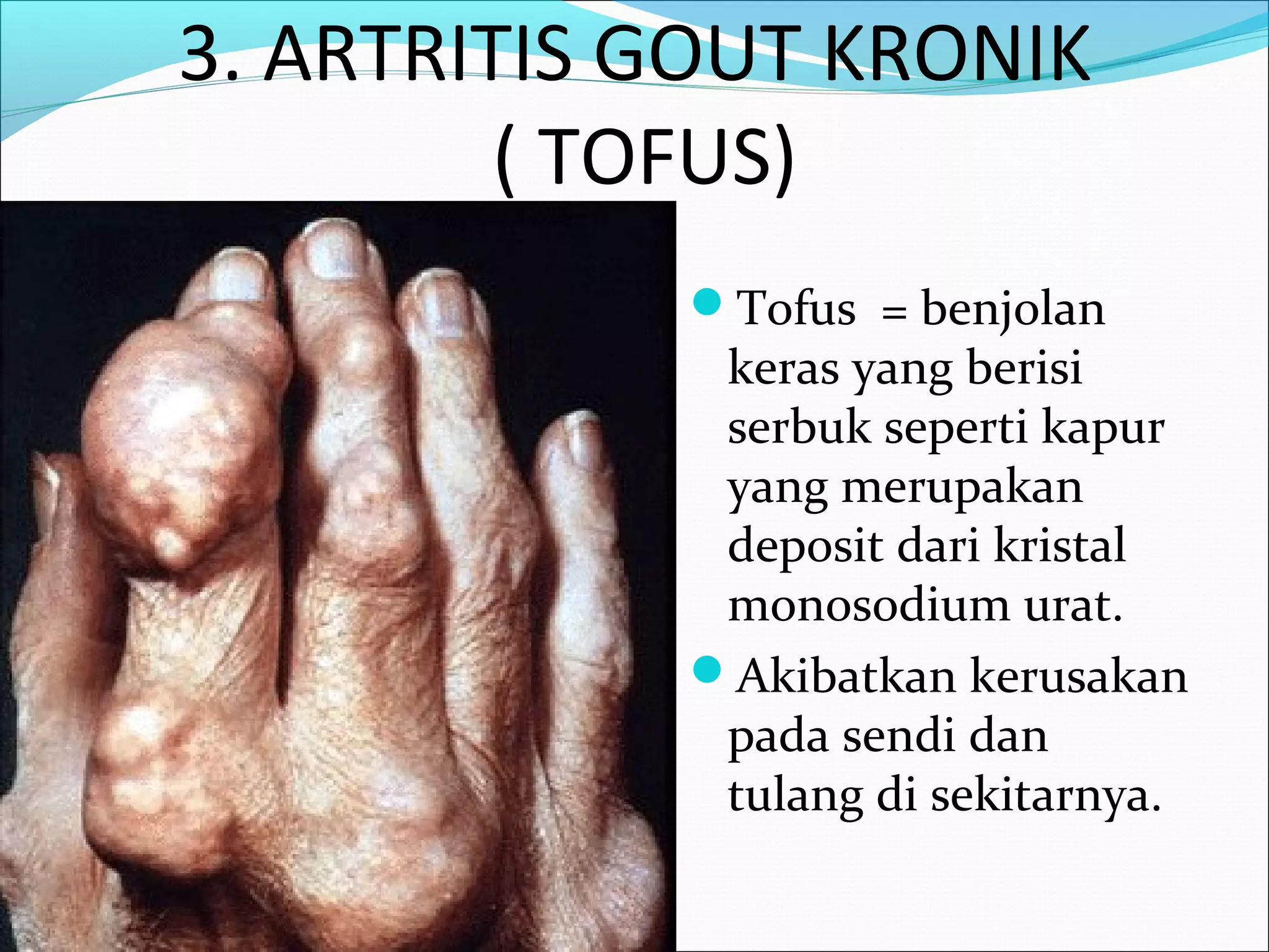 Penyakit asam urat | PPT