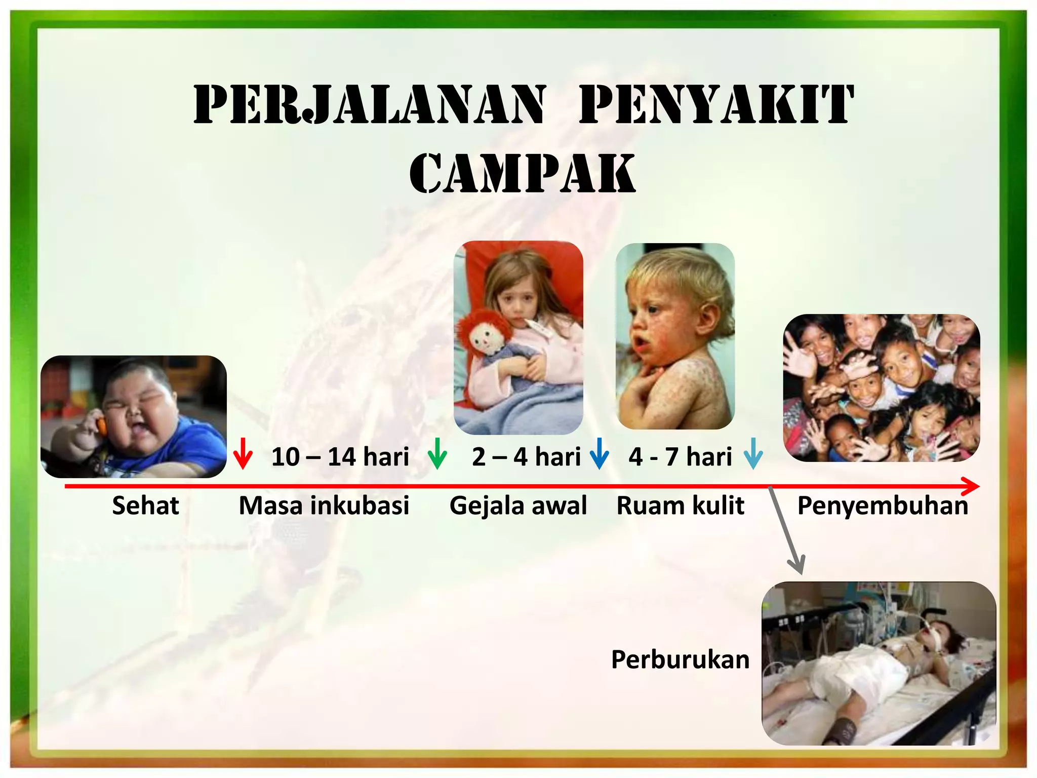 Penyakit campak measles | PPTX