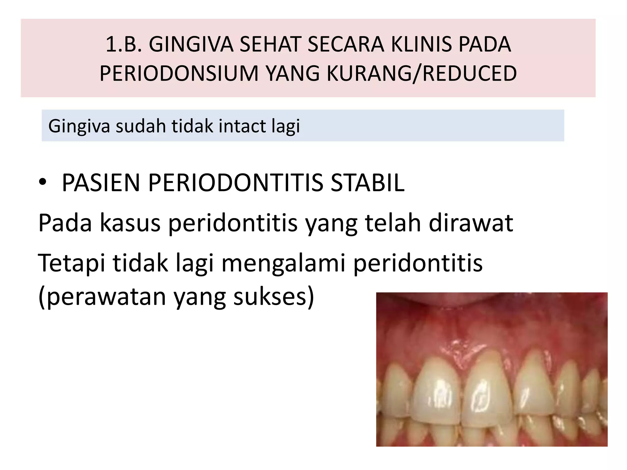 Penyakit gingiva | PPTX