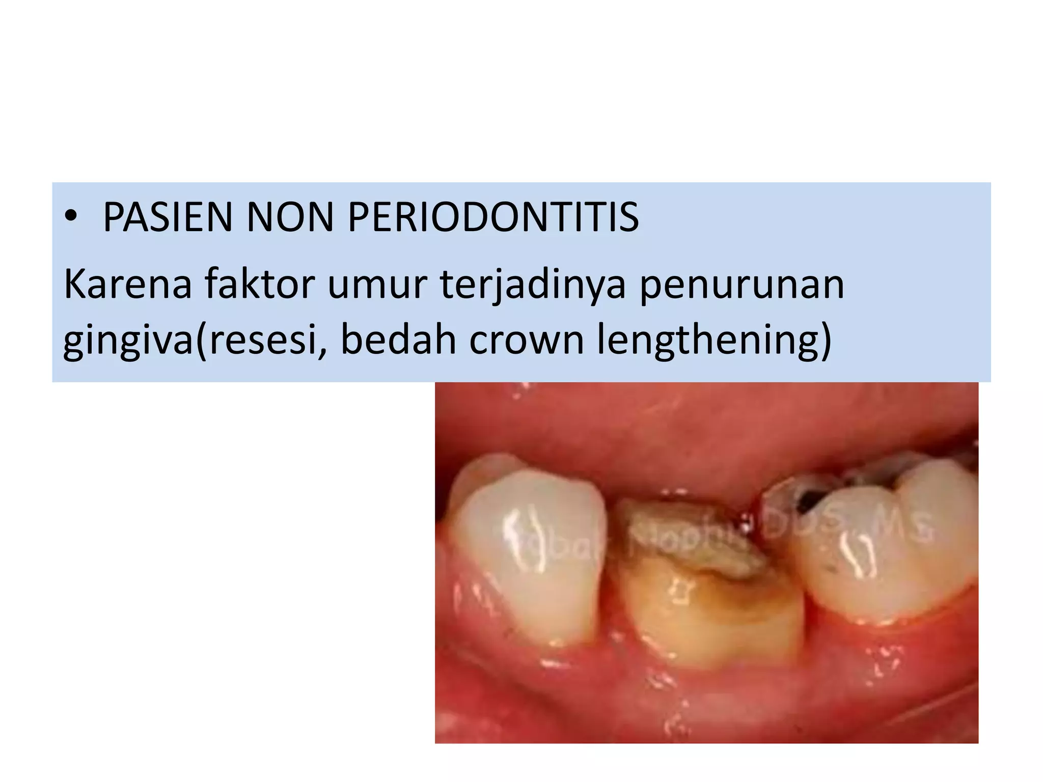 Penyakit gingiva | PPTX