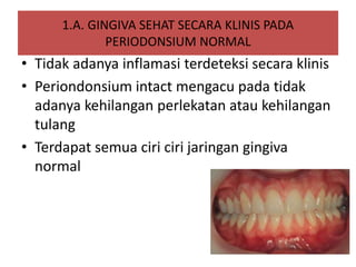 Penyakit gingiva | PPTX