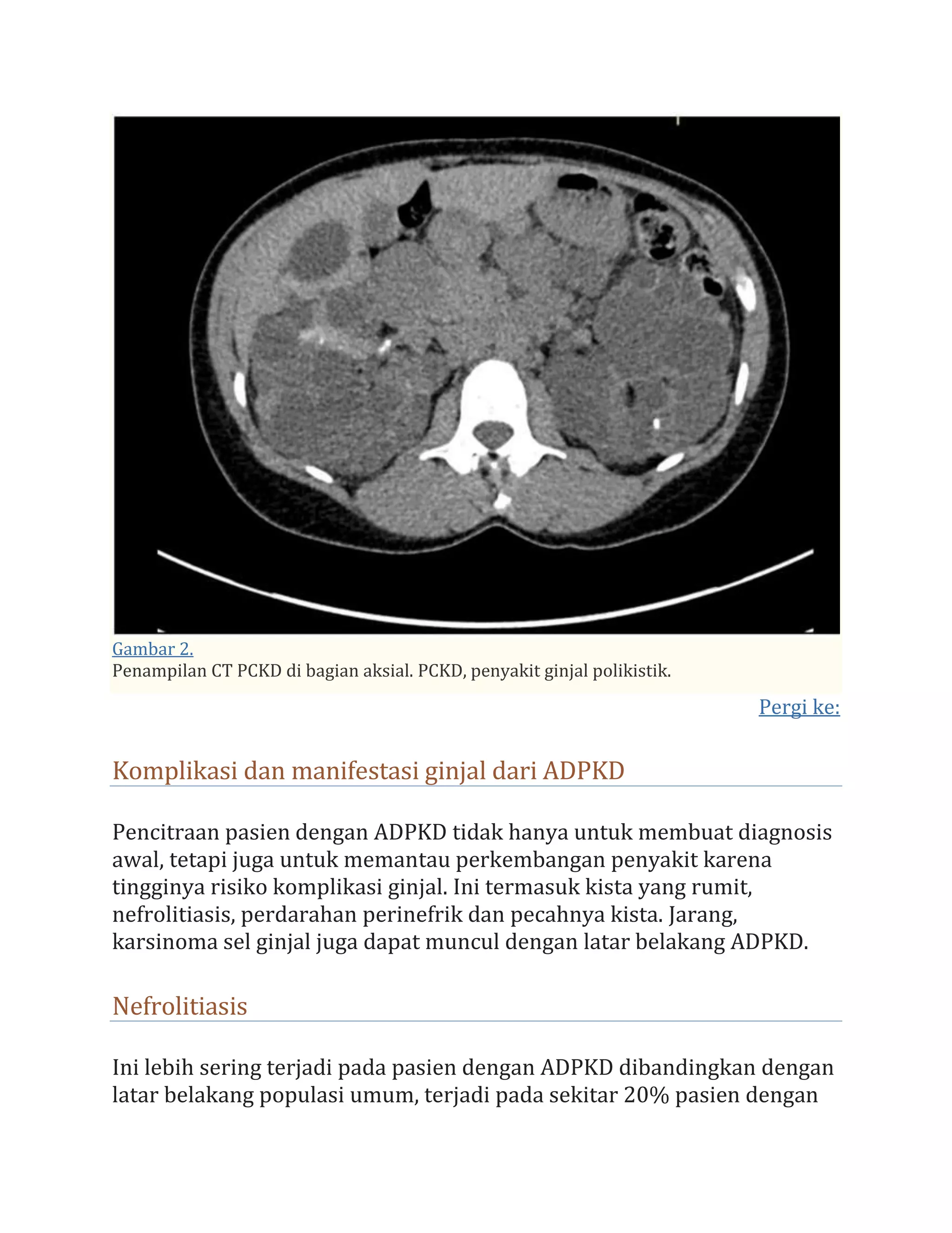 Penyakit ginjal polikistik dominan autosomal.docx