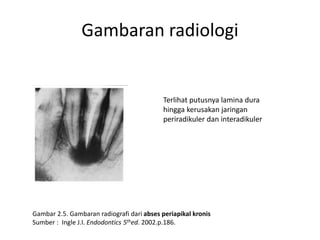 Penyakit infeksi dentomaksilofasial | PPTX
