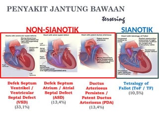 Presentasi oleh dokter spesialis Penyakit jantung anak BSTV.pptx