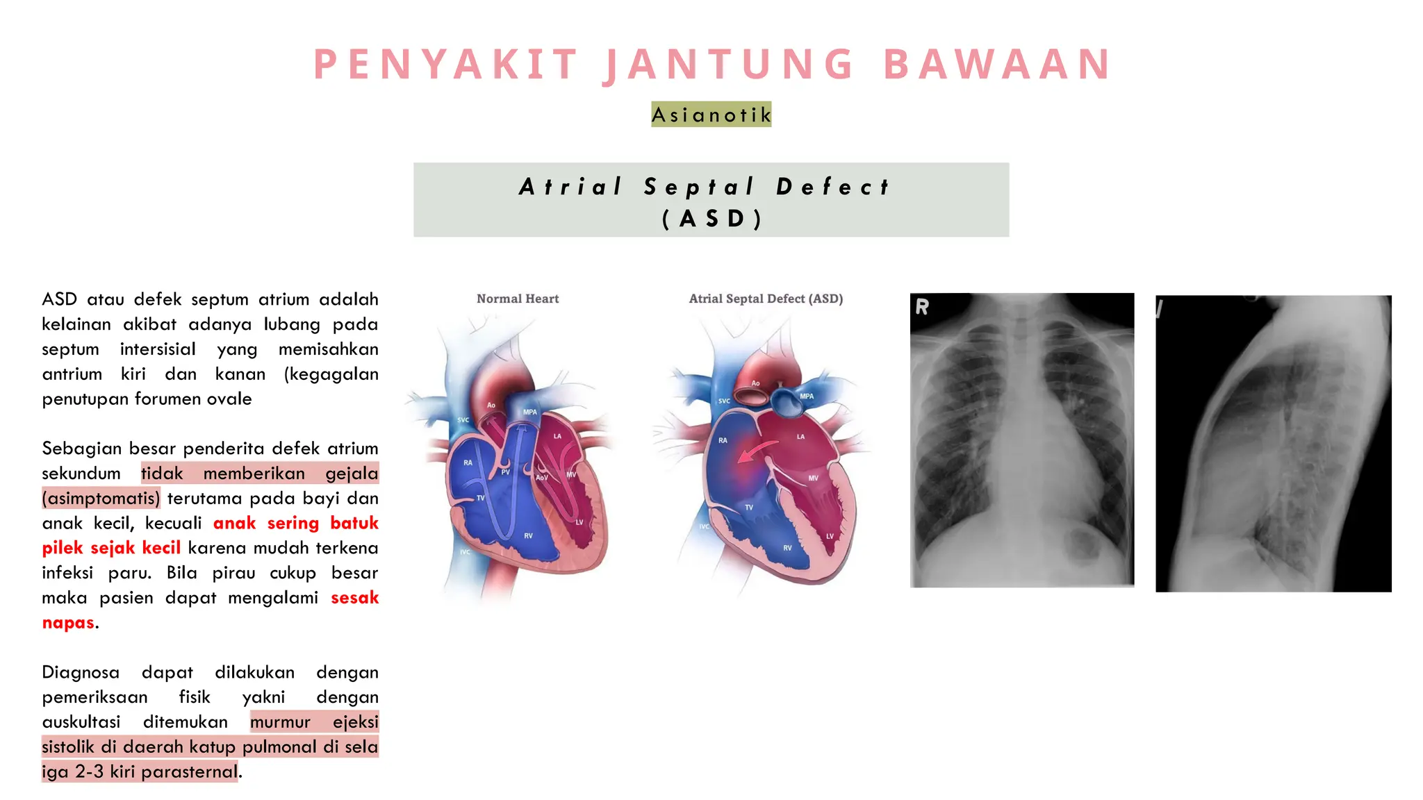 Penyakit Jantung Bawaan__ Atrial Septal Defect (ASD) | PPTX