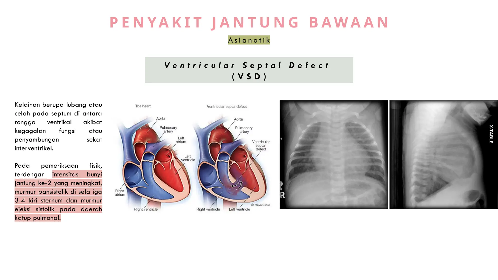 Penyakit Jantung Bawaan__ Atrial Septal Defect (ASD) | PPTX
