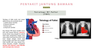 Penyakit Jantung Bawaan__ Atrial Septal Defect (ASD) | PPTX