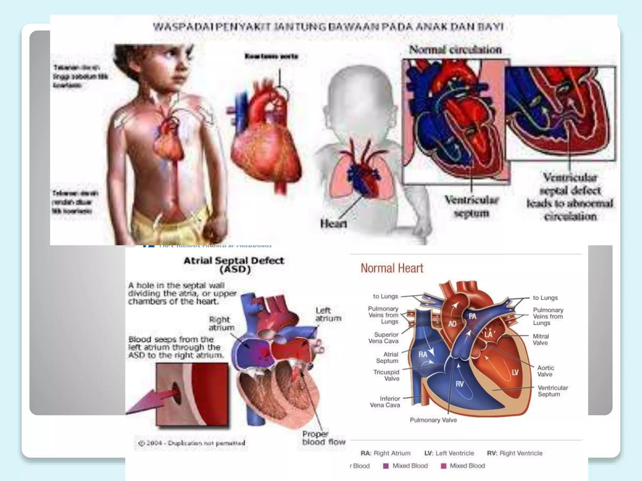 Penyakit jantung bawaan | PPTX