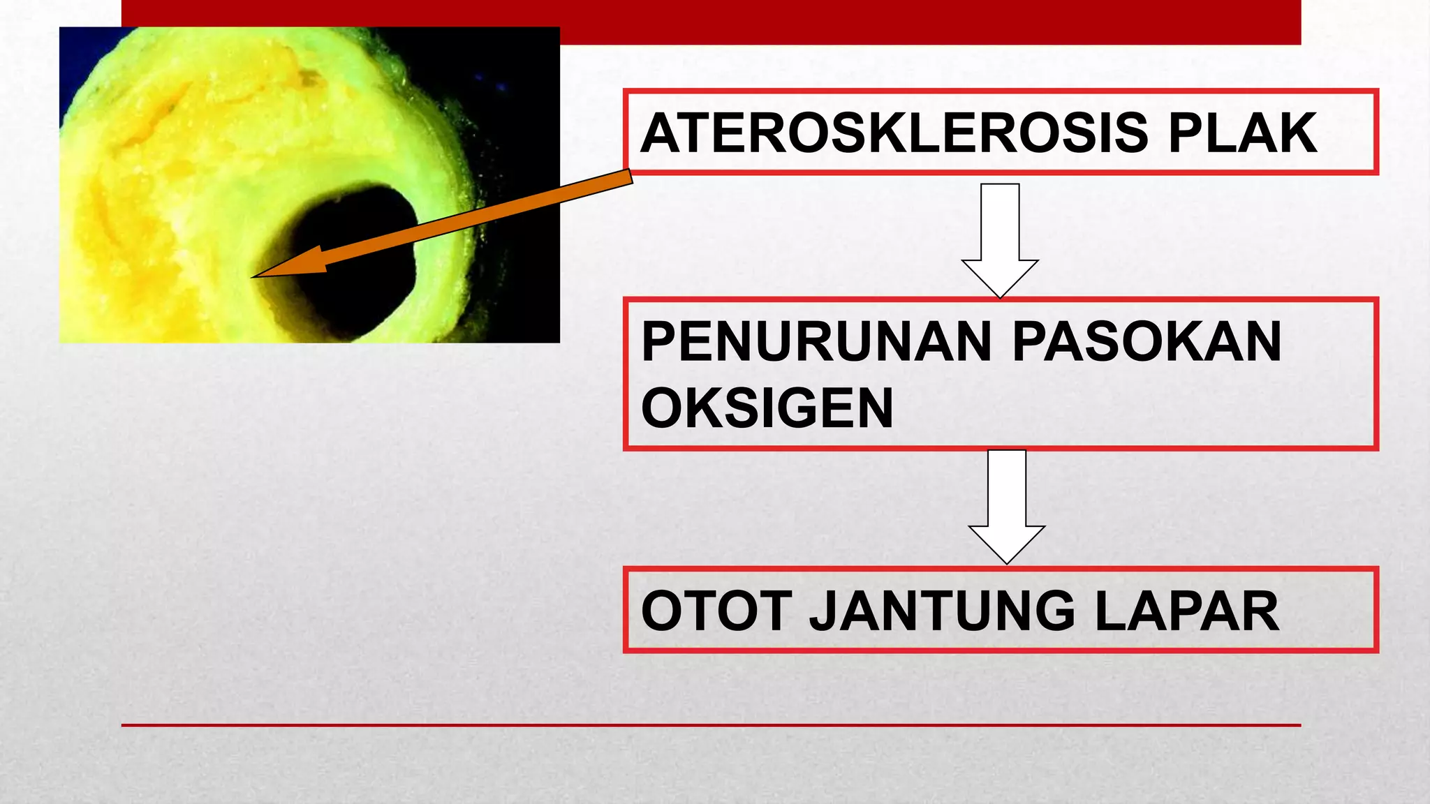 Penyakit jantung iskemik | PPTX