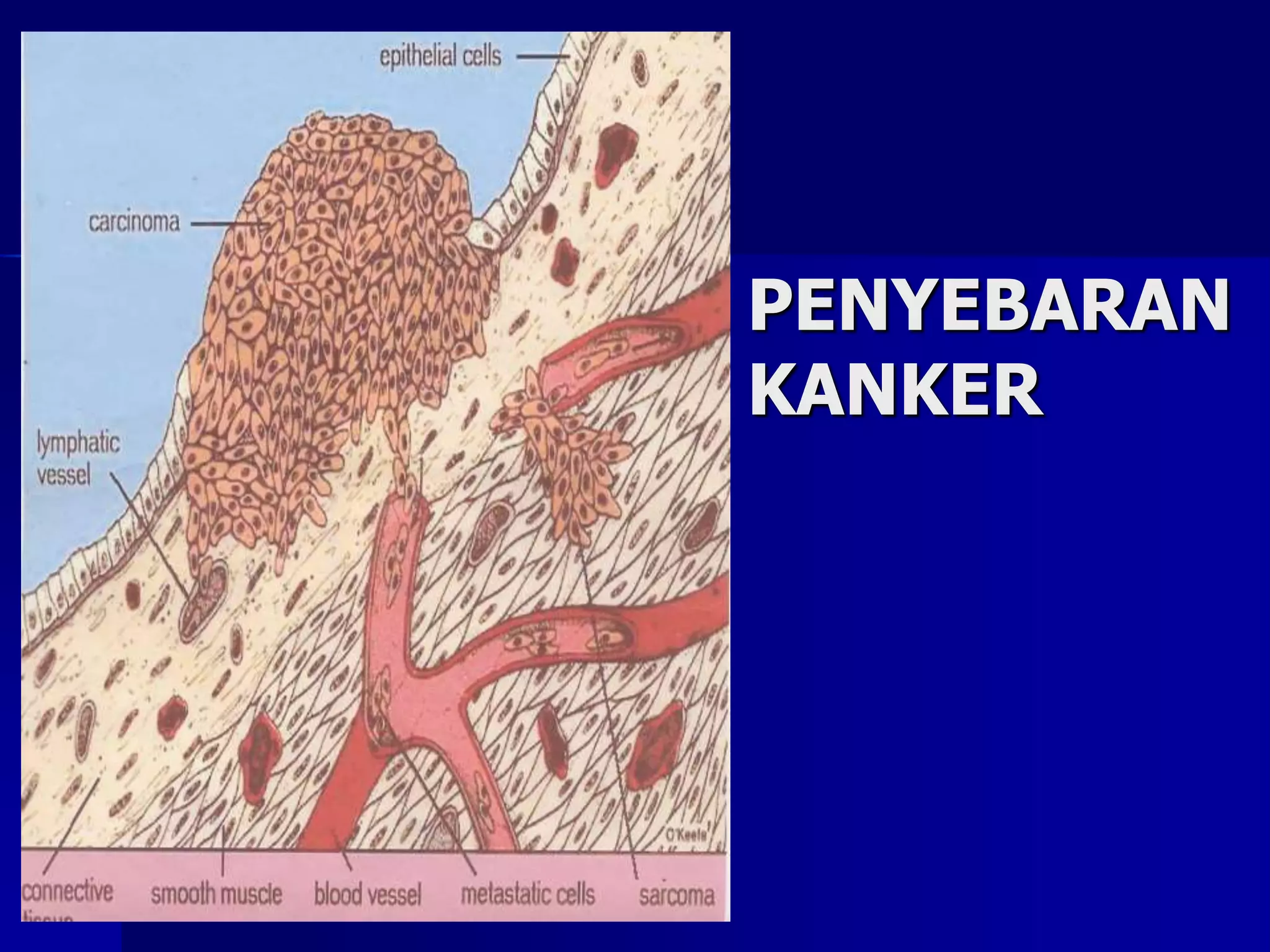 PENYAKIT KANKER 2015 BALI.ppt