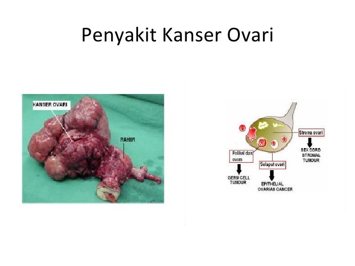Penyakit kanser ovari