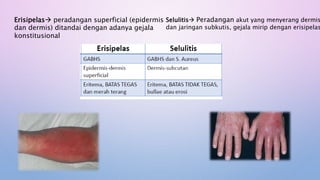 PPT Penyakit Kulit Infeksi Bakteri.pptx