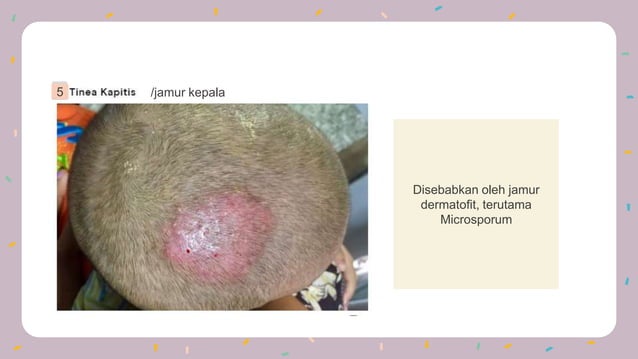 penyakit kulit pada anak.pptx