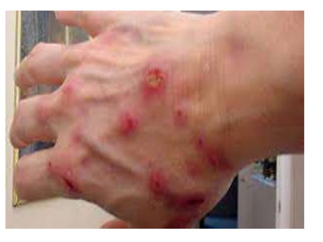 Penyakit_KUSTA_baru.ppt