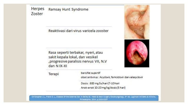 PENYAKIT LIANG TELINGA & INFLAMASI DAUN TELINGA.pptx