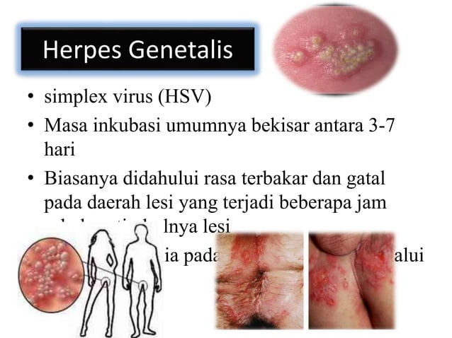 Penyakit menular seksual | PPTX