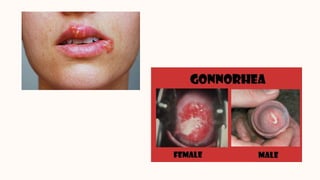 PRESENTASI penyakit menular seksual.pptx