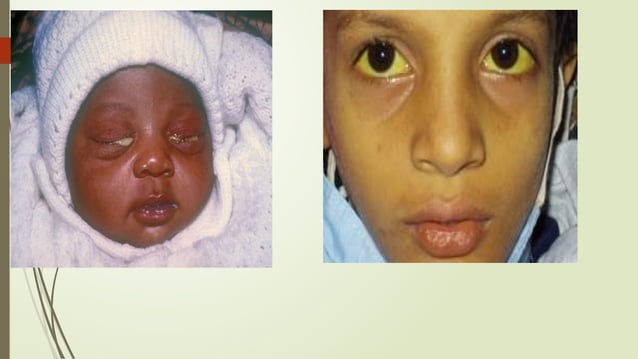 PENYAKIT MENULAR SEKSUAL(PMS).ppt.Sexual Transmitted Disease.ppt