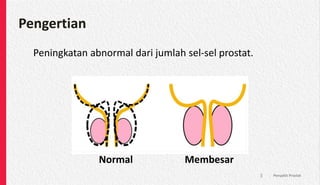 PenyakitProstat l.ppt