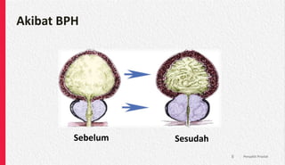 PenyakitProstat s.ppt