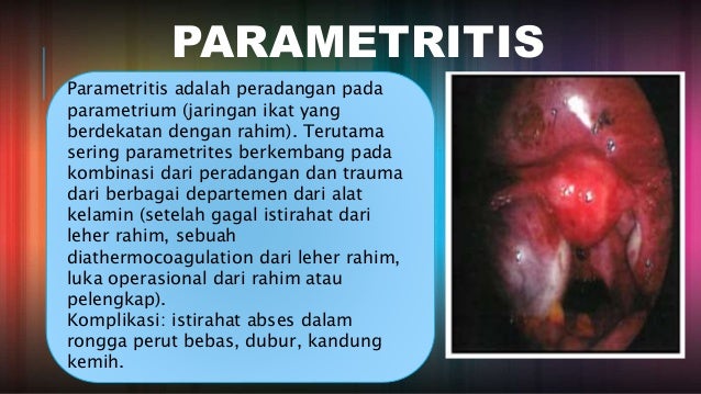 Penyakit radang panggul (pelvic inflammatory disease