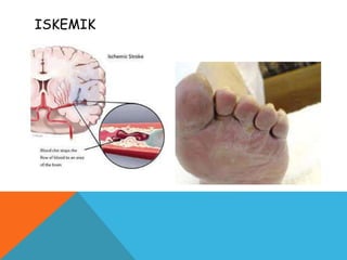 Penyakit yang disebabkan oleh radikal bebas | PPTX