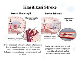 PENYAKIT_SEREBRIVASKULAR_STROKE_pptx.pptx