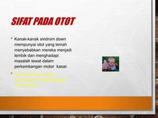 Penyakit sindrome down | PPT