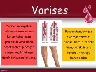 Penyakit sistem sirkulasi anisa | PPTX