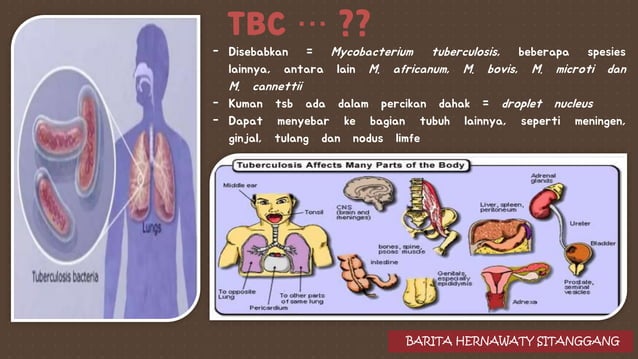 PENYAKIT TBC (tuberculosis) beserta obatnya | PPT