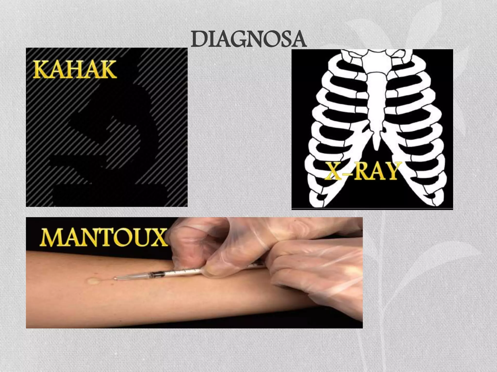 Penyakit tibi | PPTX