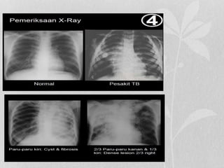 Penyakit tibi | PPTX