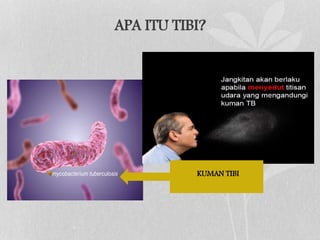 Penyakit tibi | PPTX