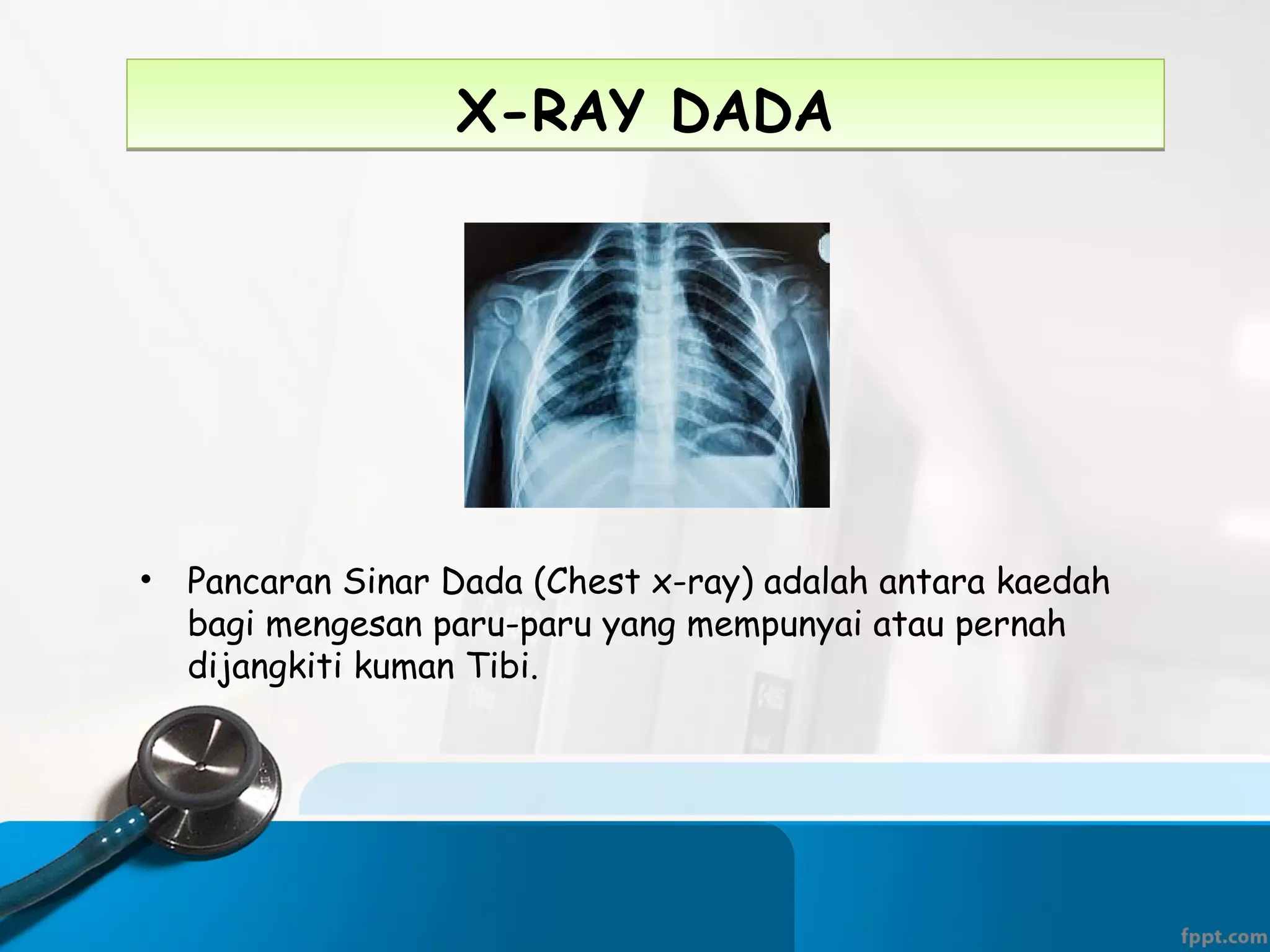 Penyakit tuberkulosis @ tibi dani | PPT