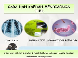 Penyakit tuberkulosis @ tibi dani | PPT